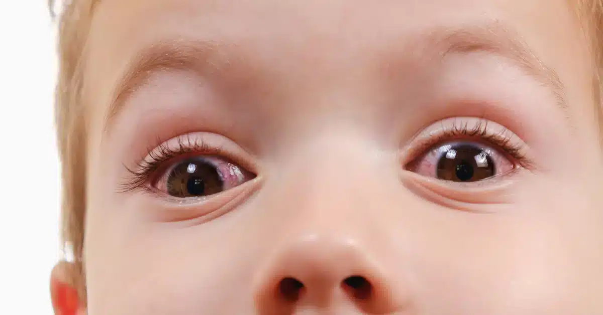 Select Your Medication: Vigamox vs Moxeza