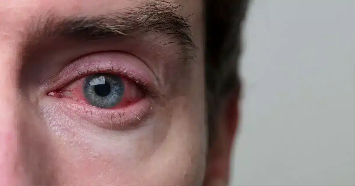 Swollen Eye From Bug Bite: Natural Remedies That Actually Work