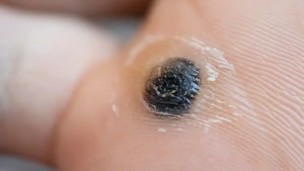 Understanding HPV Lesions: A Comprehensive Guide