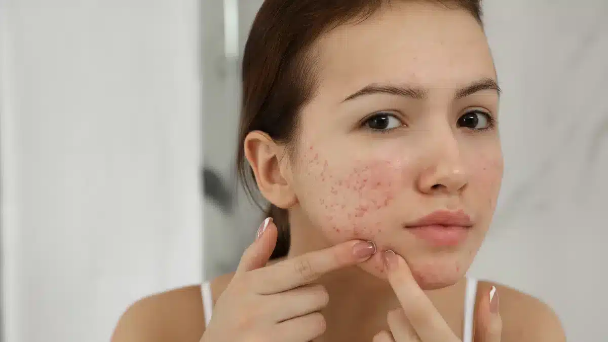 Understanding STD Pimples: Signs and Symptoms
